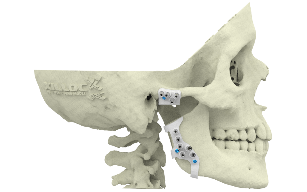 Xilloc-Medical-B.V.-Temporal-Mandibular-Joint-Implant-Groningen ...